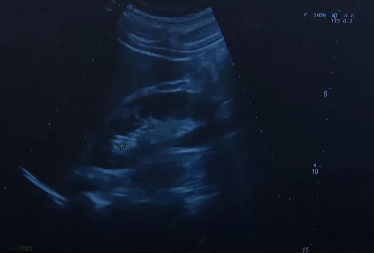 Kada treba napraviti ultrazvuk abdomena i što se vidi na njemu: Ako ...
