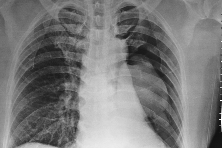 Pneumotoraks - Zašto nastaje? Kako ga liječiti?