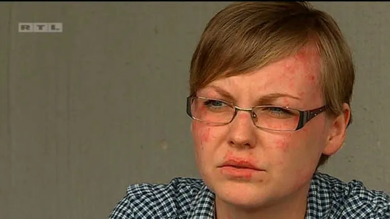 Doznajte što je lupus - autoimuna bolest koja u 90 posto slučajeva ...